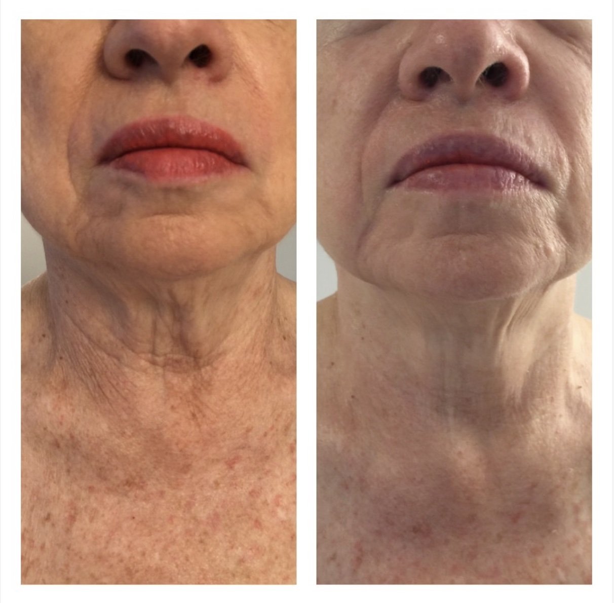 CO2 Lift Pro Mask Trio